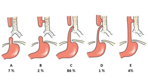 ATRESIA ESOFAGEA - Associazione Libera Malati Acalasia e altre malattie ...